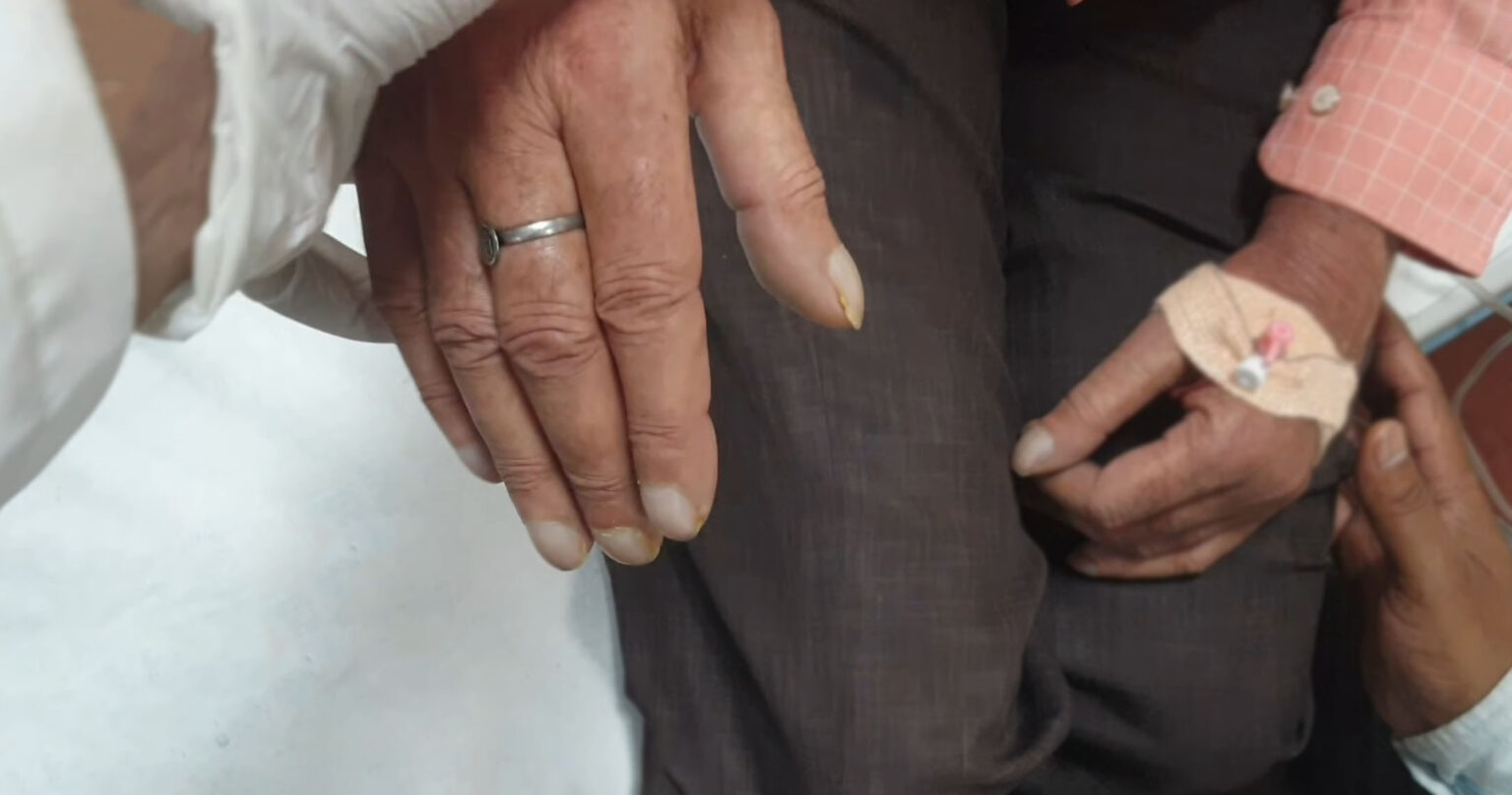 Causes of Finger Clubbing - Symptoms & Treatment