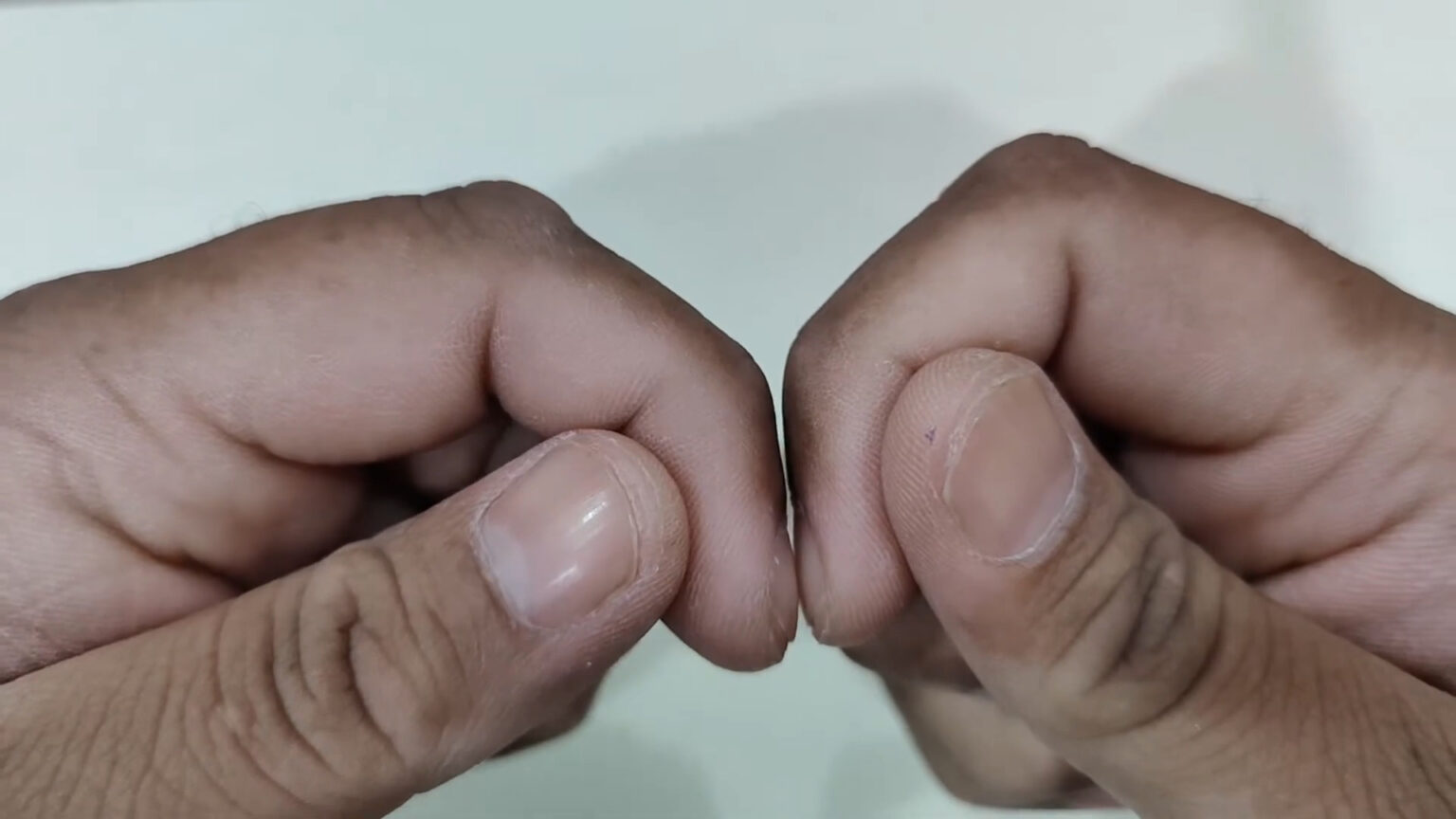 Causes of Finger Clubbing - Symptoms & Treatment