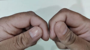 Causes of Finger Clubbing - Symptoms & Treatment